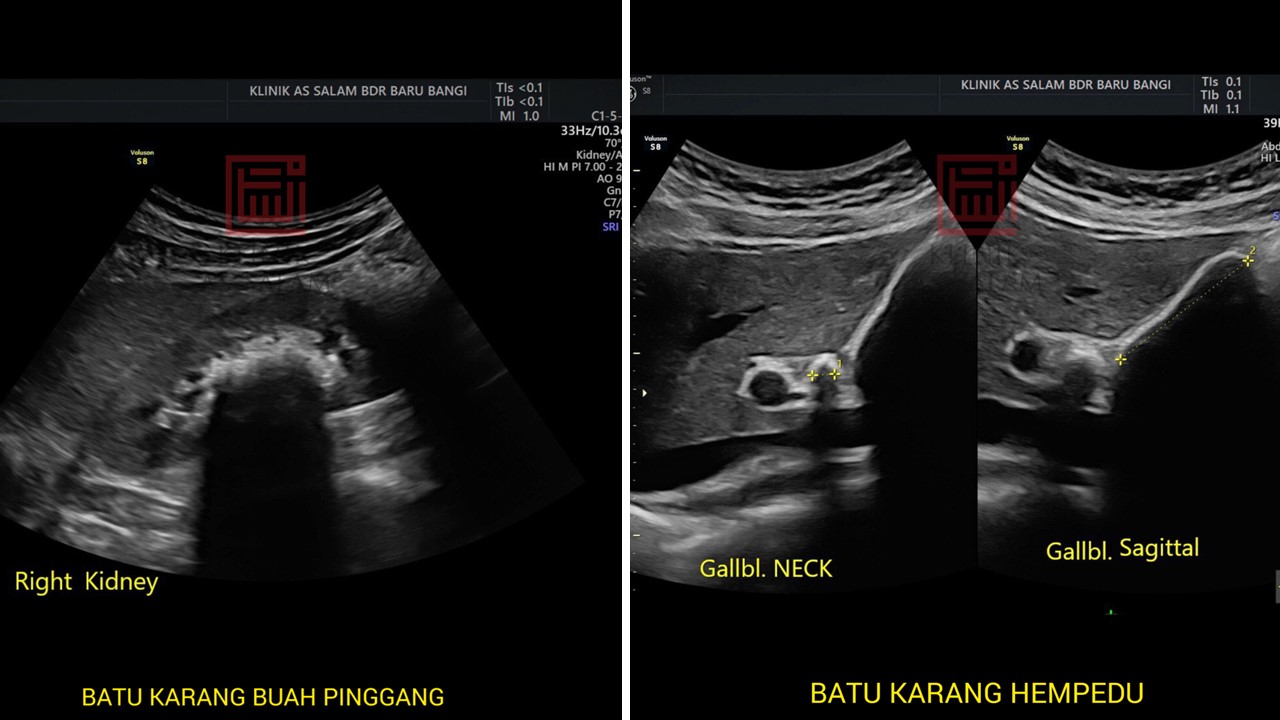 Batu Karang Dalam Hempedu Vs Batu Karang Buah Pinggang