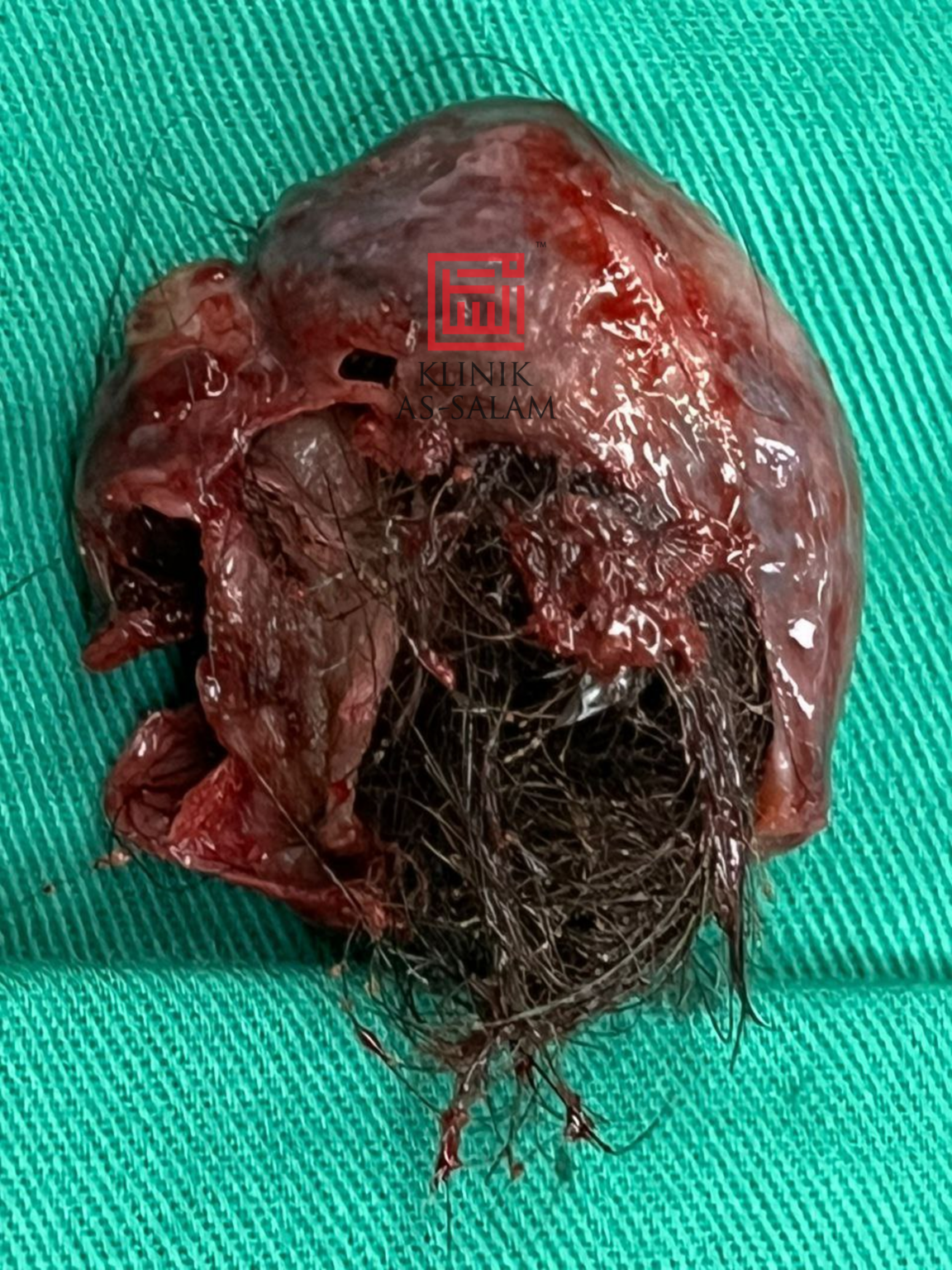 Apa Itu Ovarian CYST Digeruni Wanita | Punca & Simpton