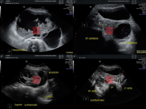 Apa Itu Ovarian CYST Digeruni Wanita | Punca & Simpton